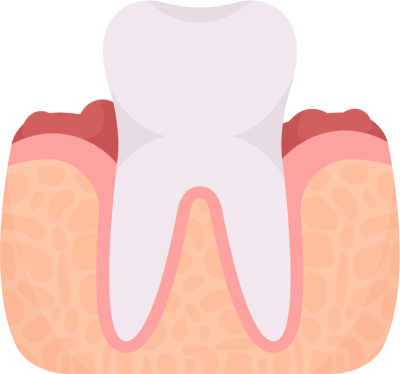 Gingivitis - Clínica Dental Julián Saiz